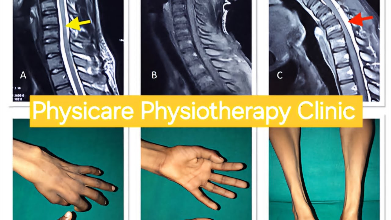 Cervical Myelopathy | Hirayama Disease | Hand Rehabilitation | Dr ...