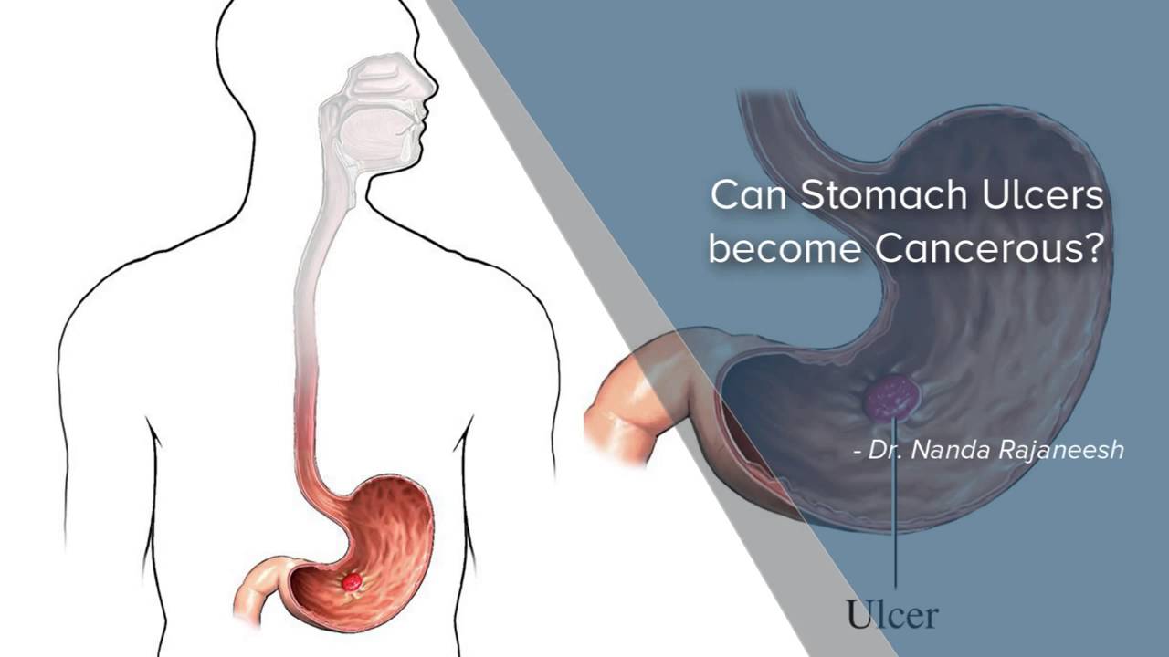 Can Stomach Ulcers become Cancerous? - YouTube