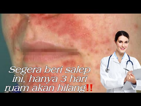 DERMATITIS PERIORAL / RUAM DI WAJAH AKIBAT PEMAKAIAN SKINCARE DI AREA ...