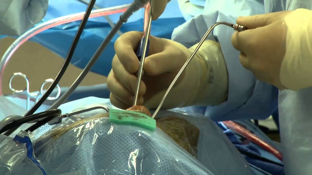 Doctors Perform Brain Surgery...Through the Nose! - YouTube