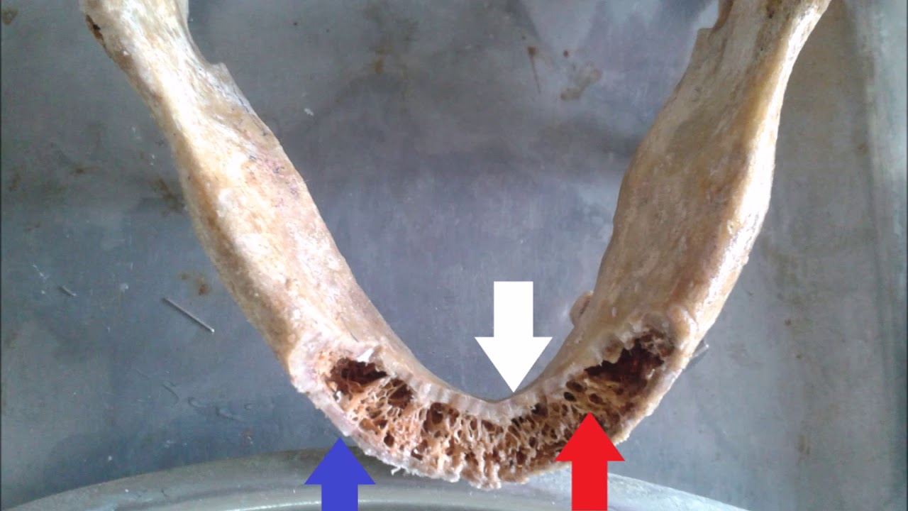 Genioplasty technique on human skull - YouTube