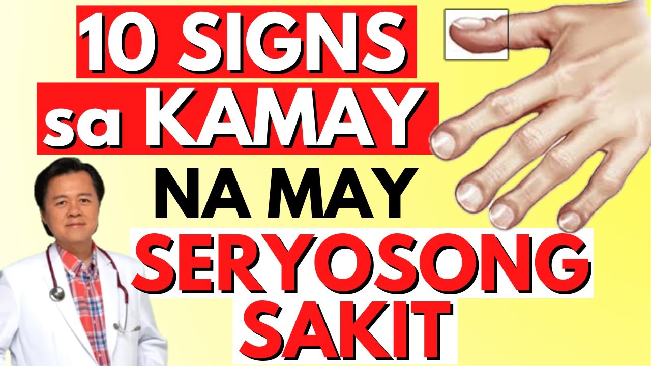 10 Signs sa Kamay na May Seryosong Sakit - Payo ni Doc Willie Ong - YouTube