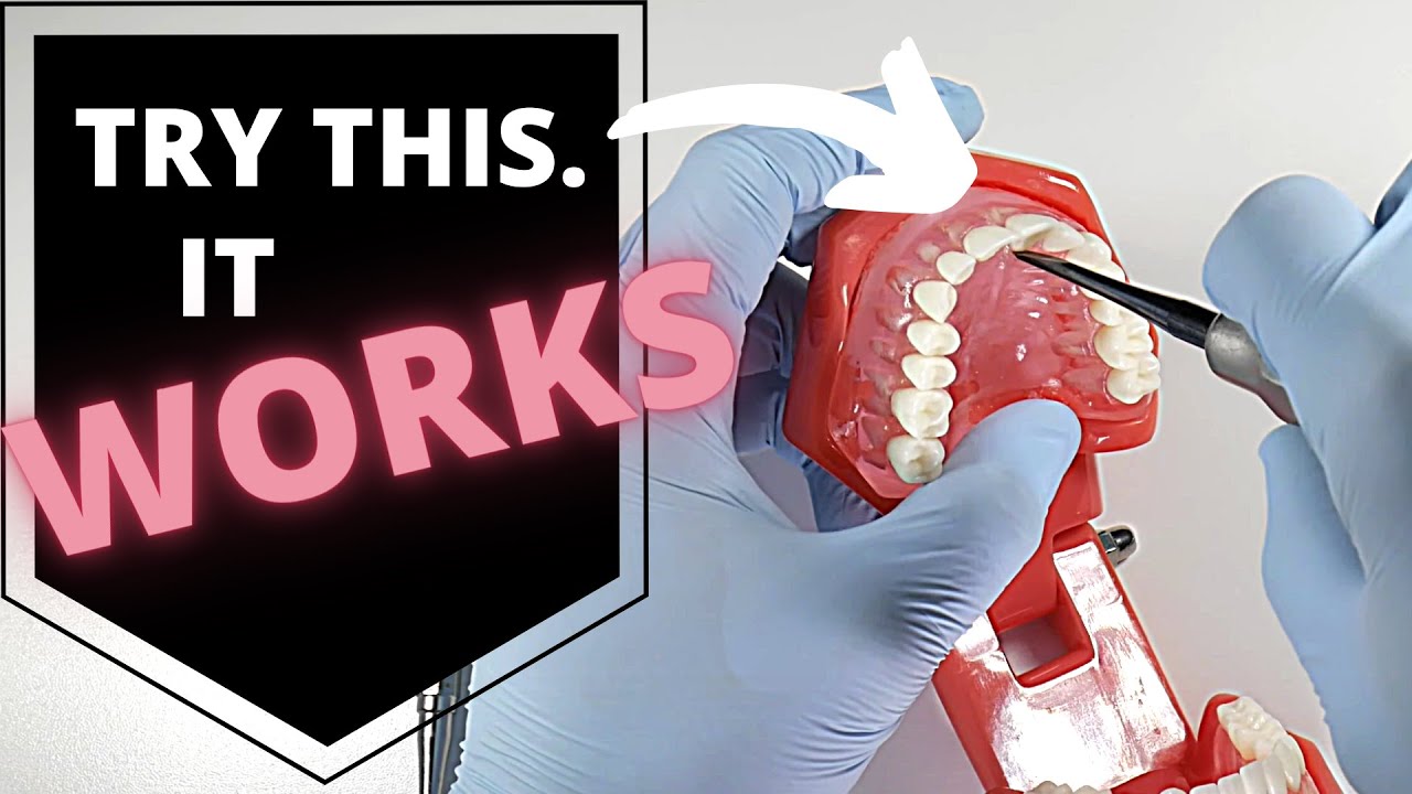 An Atraumatic Approach To Extracting Upper Central Incisors ...