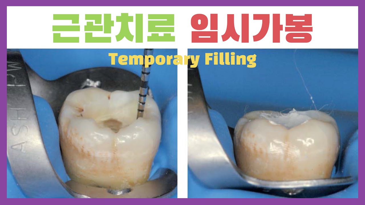 임시가봉 Temporary filling in endodontics - YouTube