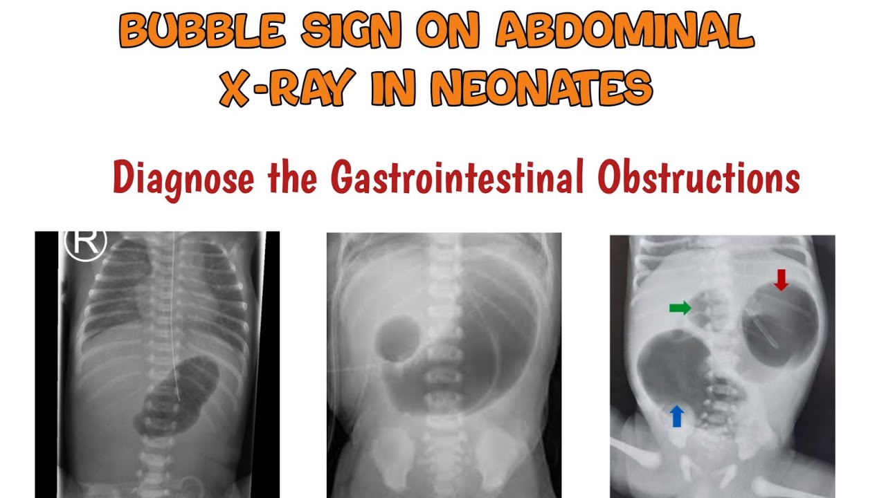Signs in intestinal obstruction | Bubble signs on Abdominal x-ray ...