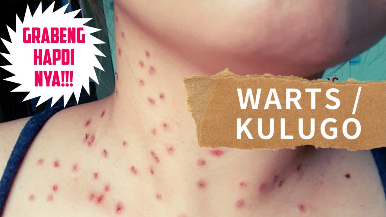 SOBRANG DAMING KULUGO SA LEEG?!!! PAANO MAWALA? MAGKANO IPATANGGAL? # ...