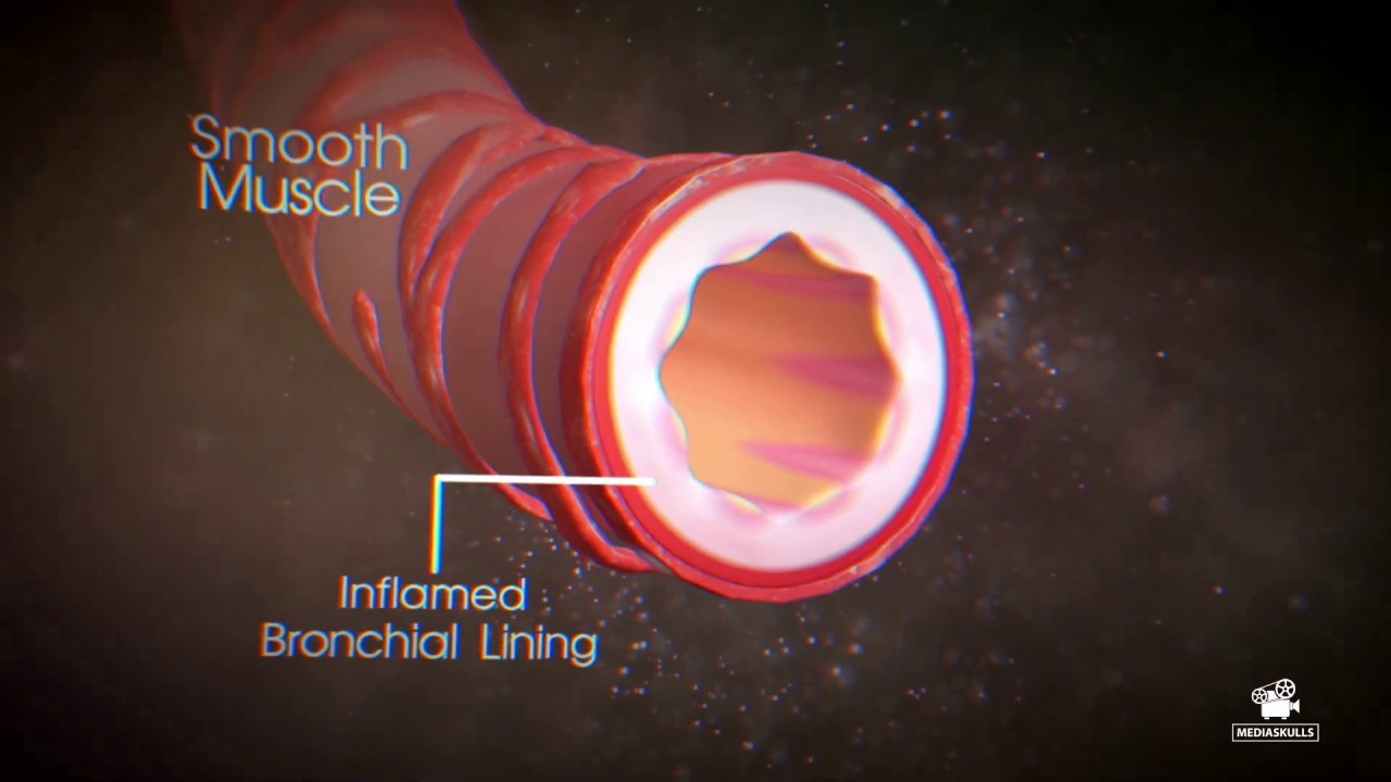 Asthma | 3D Animation | MediaSkulls - YouTube