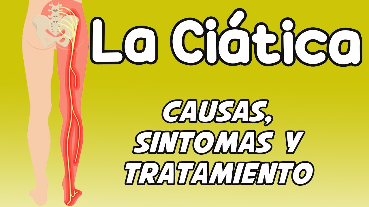LA CIÁTICA, Causas, síntomas, diagnóstico y tratamiento - YouTube