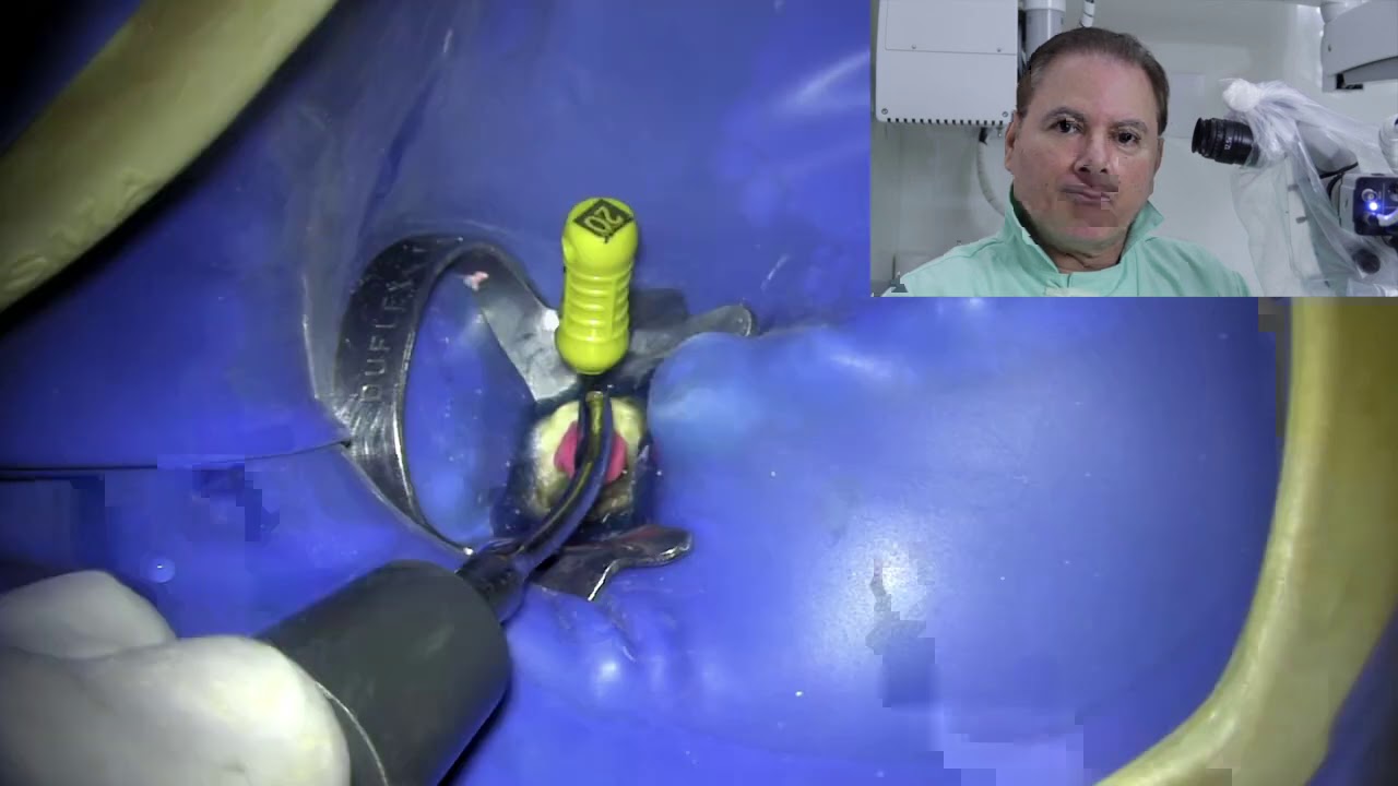 Retratamento de Canal com Patência e Limpeza do Forame Apical - YouTube