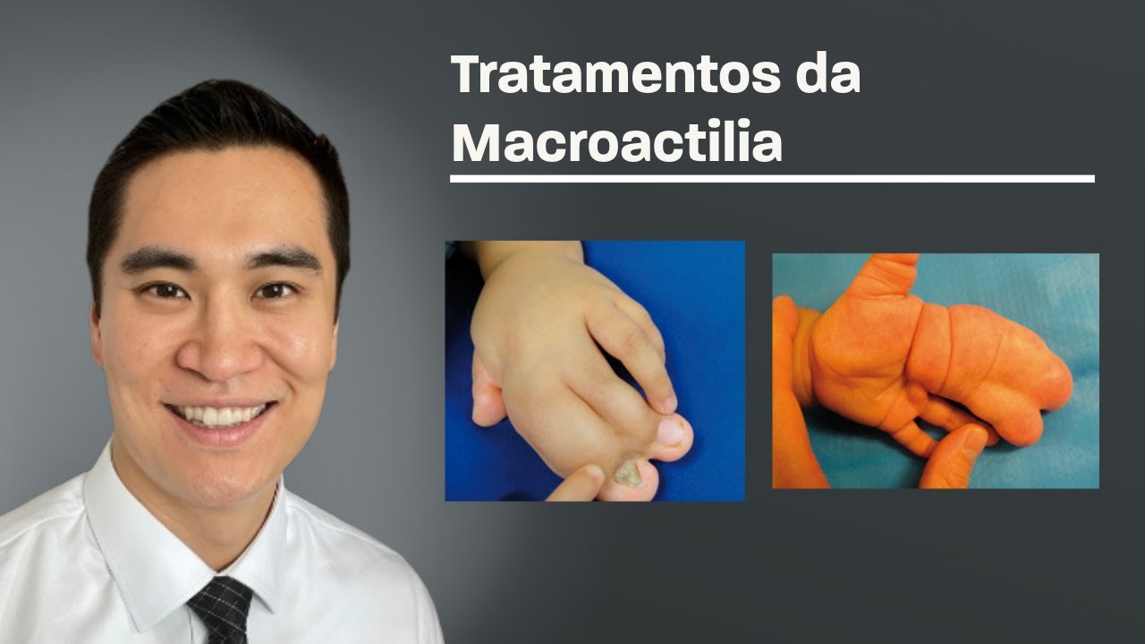Tratamento cirúrgico da Macrodactilia - YouTube