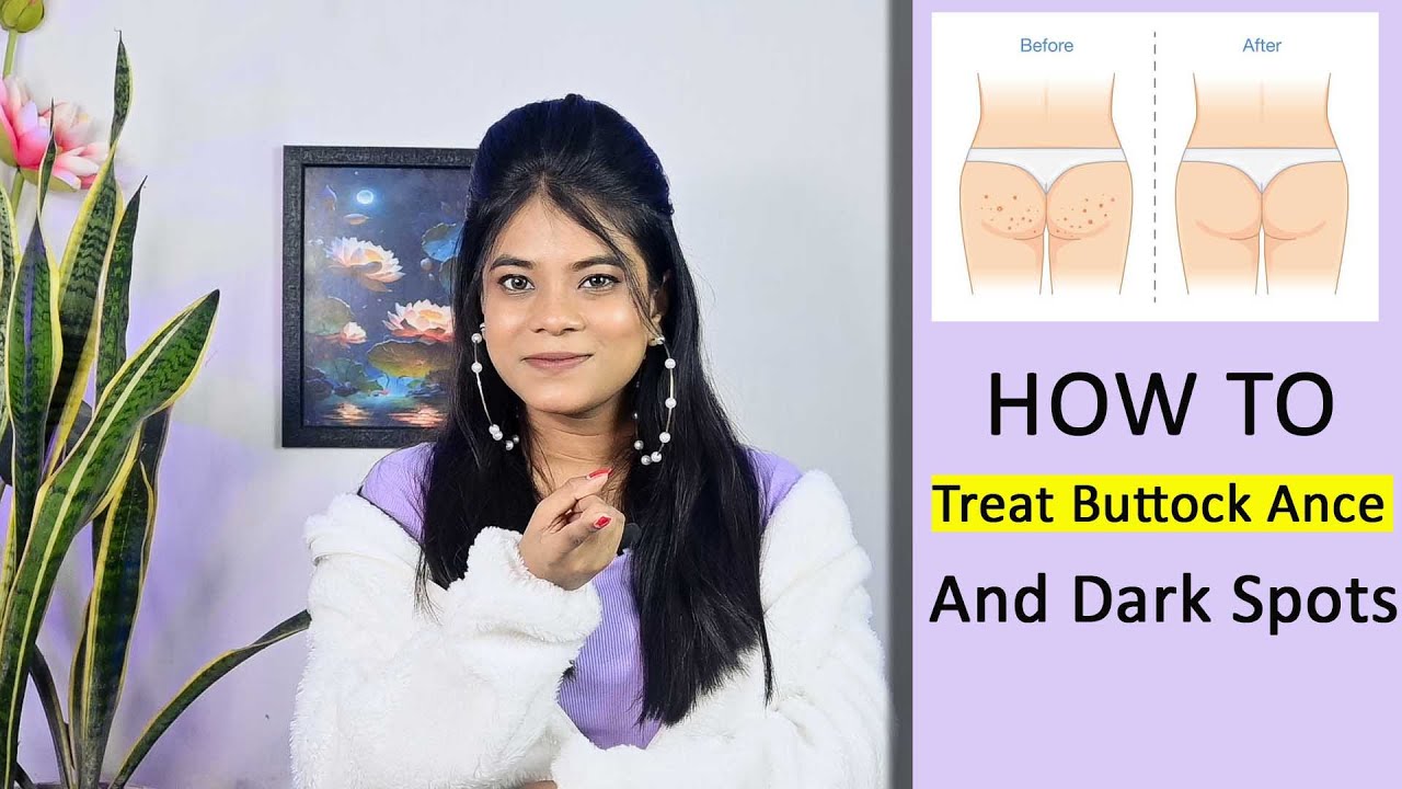 how to treat buttocks acne and dark spots | clean buttock - YouTube