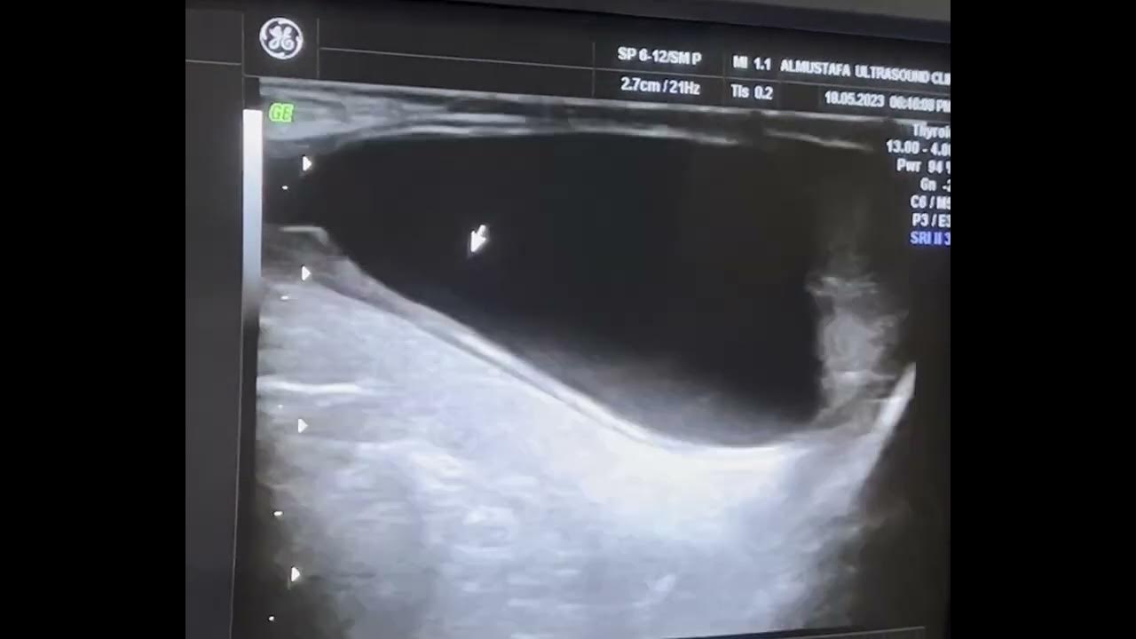 Encysted Hydrocele Diagnostic Ultrasound Cases Youtube