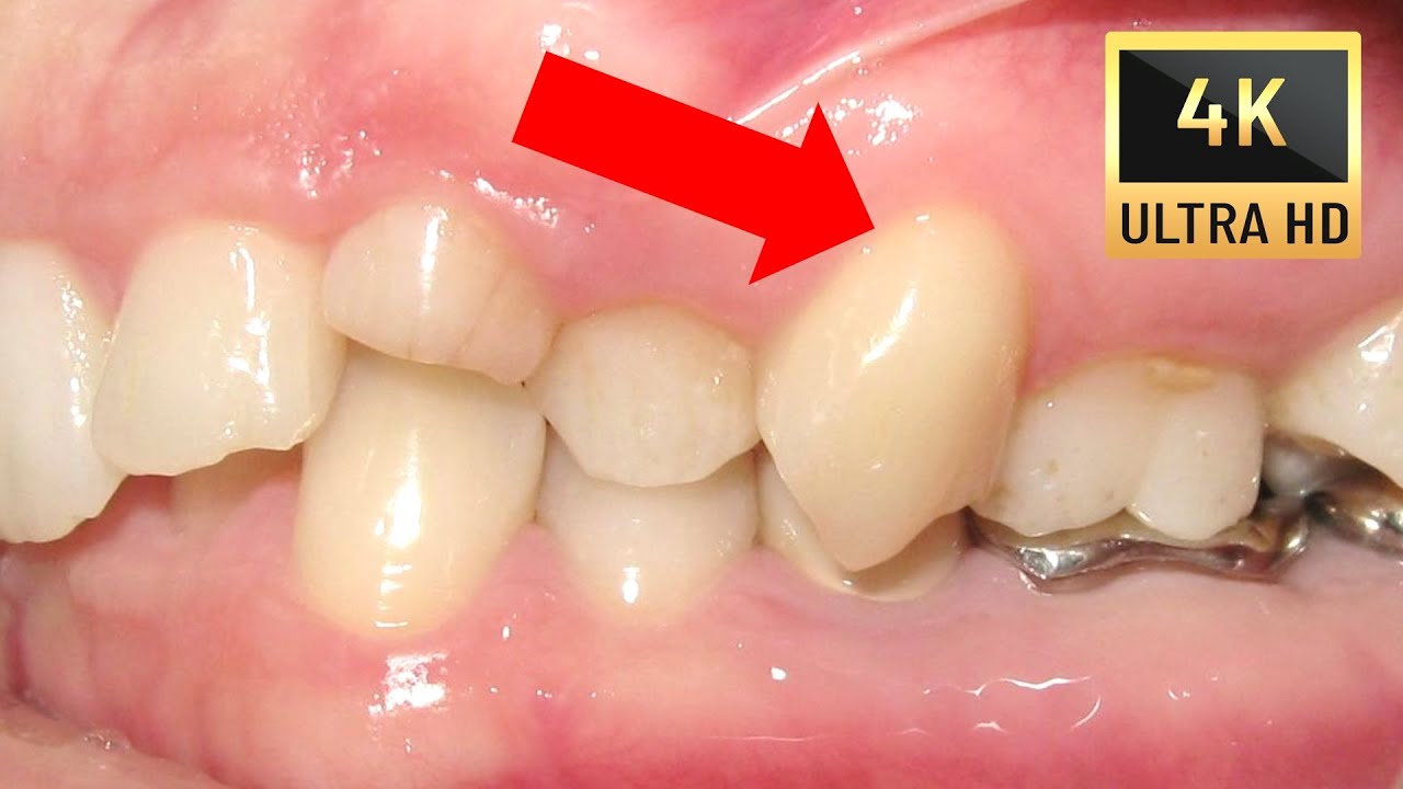 🤔 Rare TRANSPOSITION of a Canine IN CONTACT with the MOLAR 🦷 in 4K ...