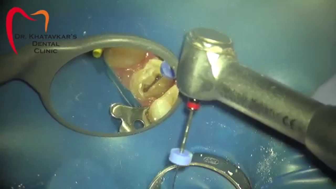 XP-Endo Finisher - A New Irrigant Activation Tool - YouTube