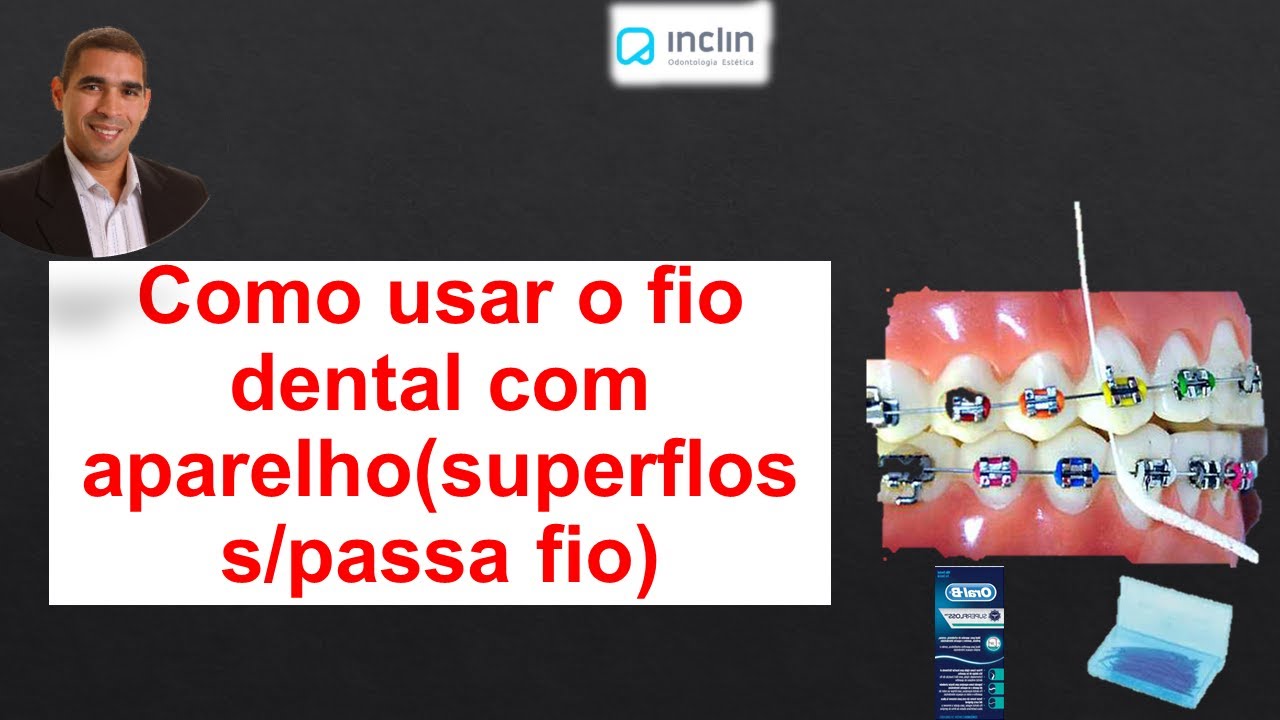 Como usar o fio dental com aparelho(superfloss/passa fio). @dr ...