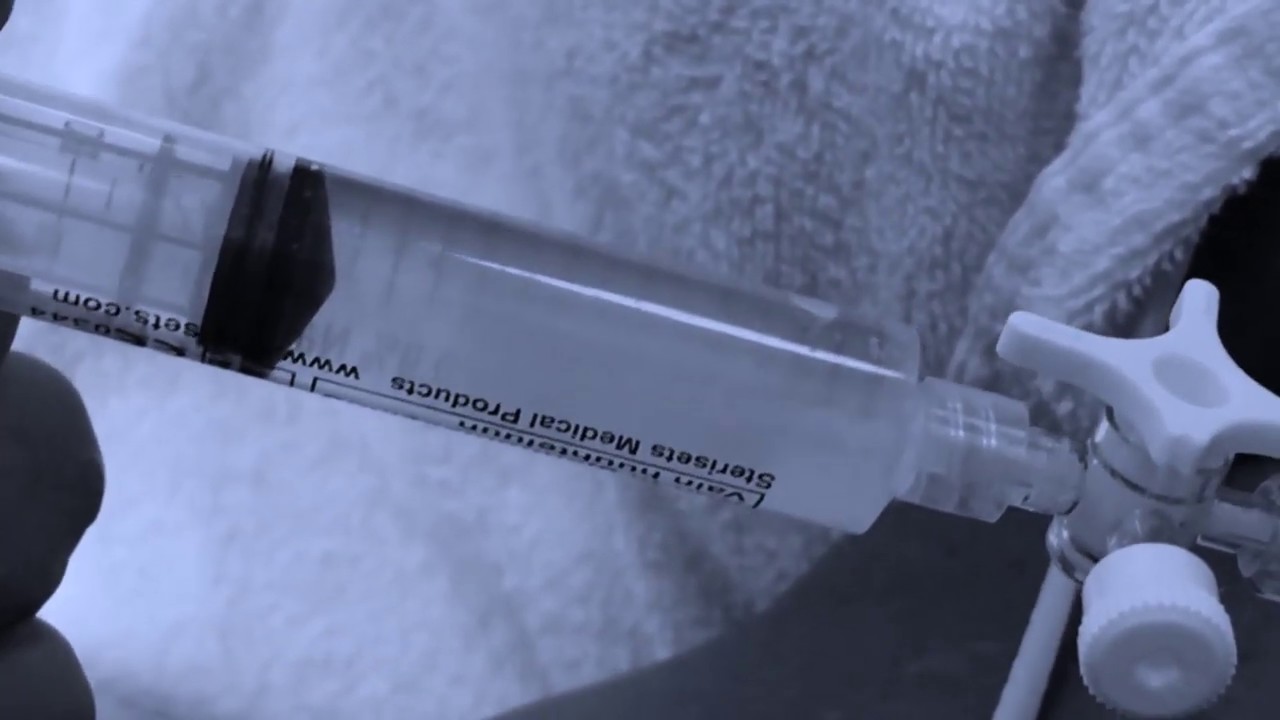 Ultrasound guided barbotage procedure for calcific tendinopathy of the ...