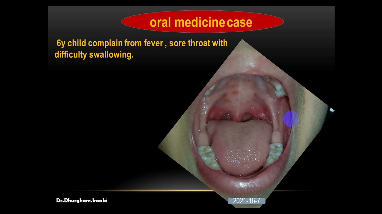 herpangina oral medicine طريقة التشخيص والعلاج - YouTube