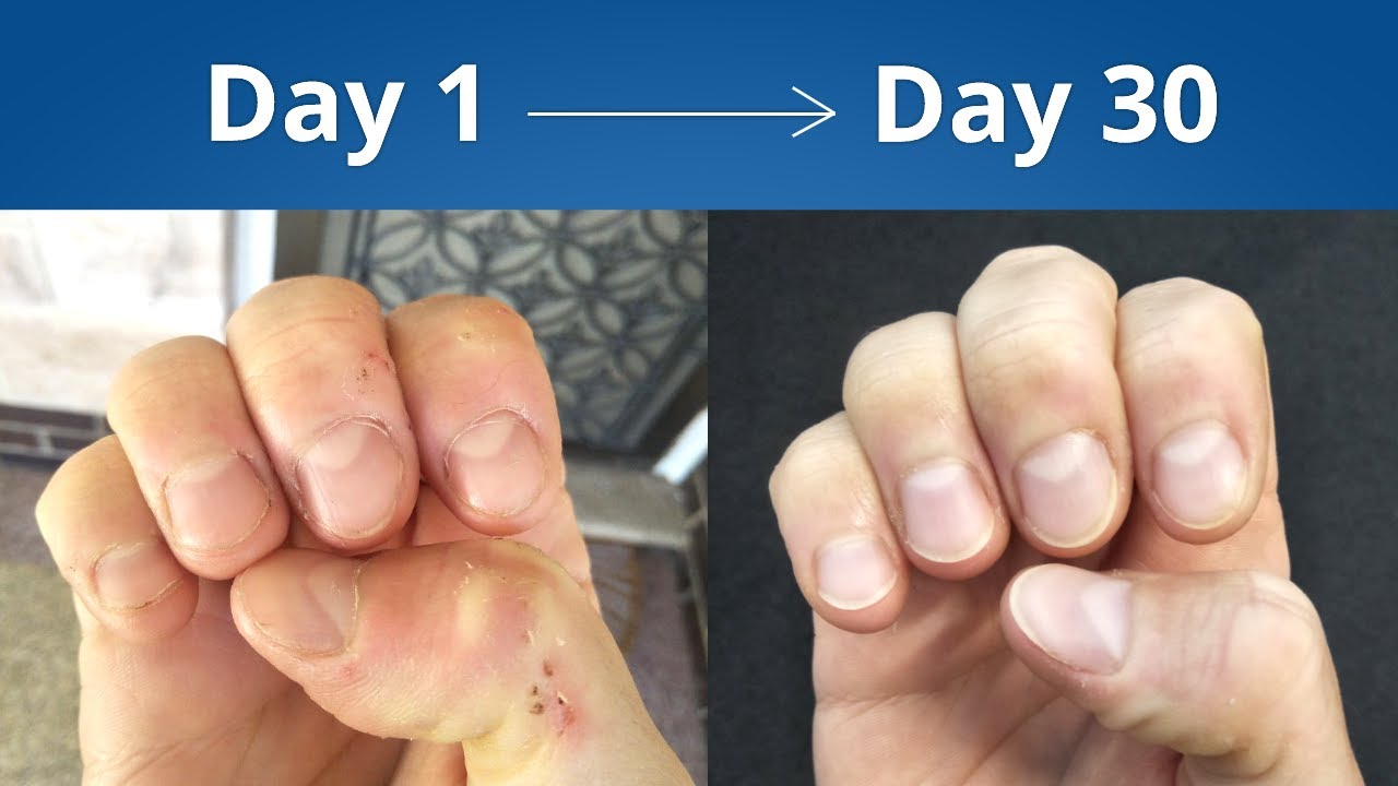 How I Stopped Biting My Fingernails In 30 Days YouTube