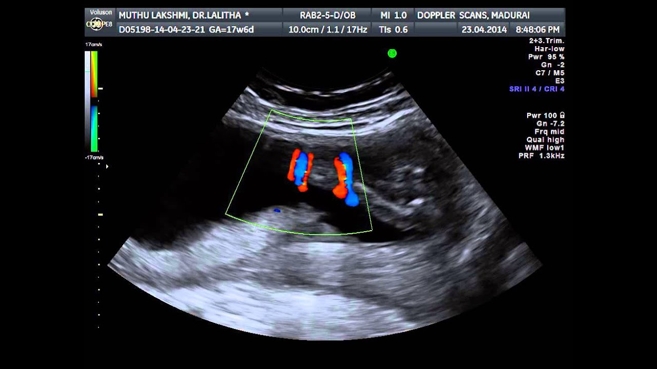LOOPS OF CORD AROUND LOWER LIMBS OF FETUS - YouTube