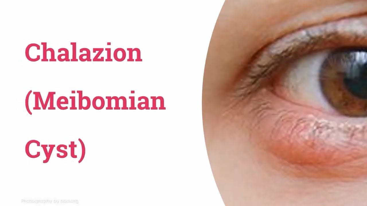 Chalazion or Meibomian Cyst - YouTube