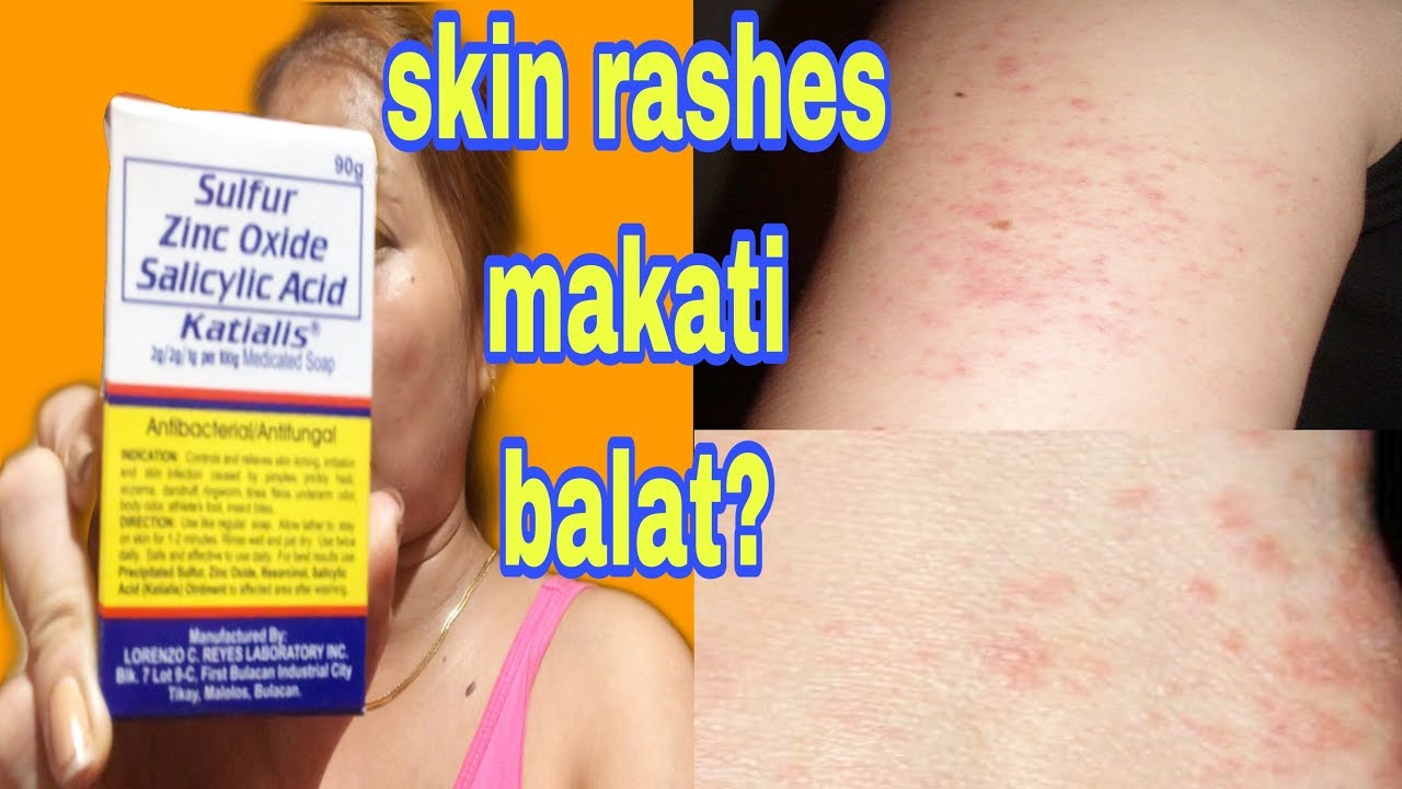 VLOG#158 SABON PARA SA MAKAKATI AT USO SAKIT SA BALAT NGAYONG SUMMER ...