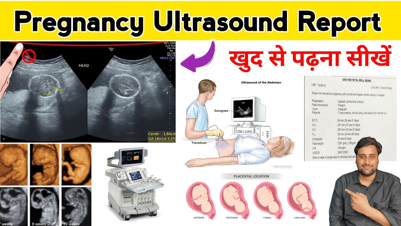 Pregnant महिला की Ultrasound रिपोर्ट। Pregnancy Sonography । USG ...