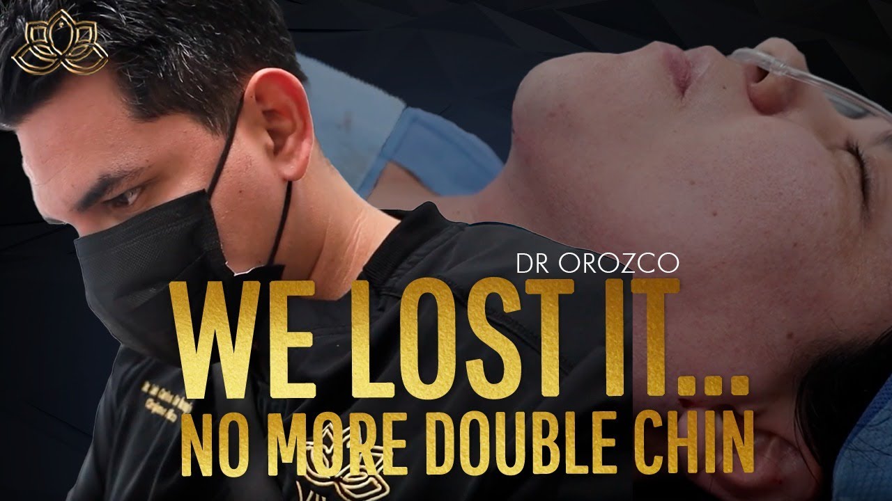 Chin Lipo Results! Amazing transformation by Dr Orozco- Vive Plastic ...