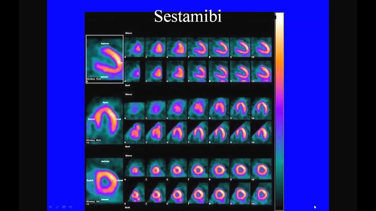 Tests and procedures to analyze the heart and blood vessels - YouTube