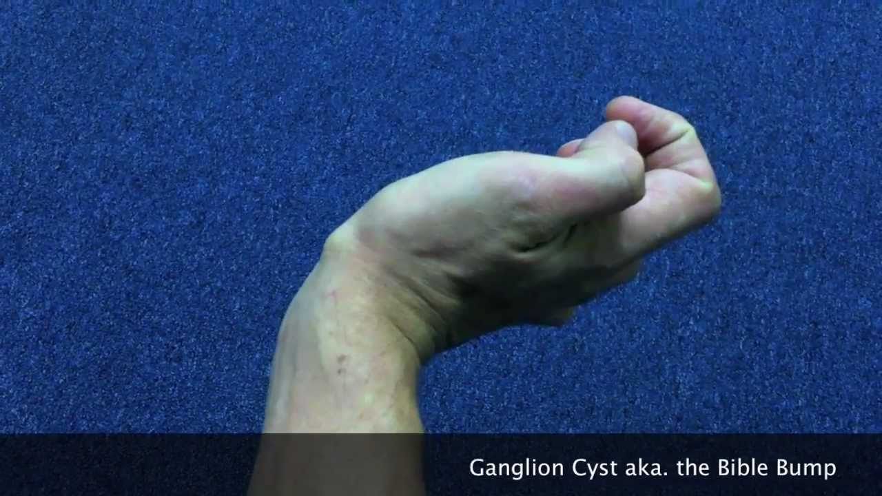 You Decide My FATE = Ganglion Cyst aka. the Bible Bump - YouTube