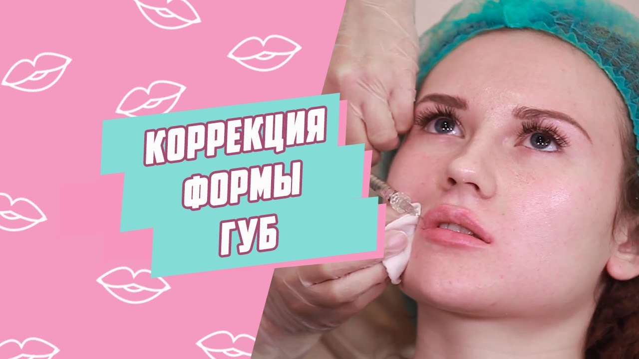 УВЕЛИЧЕНИЕ ГУБ ФИЛЛЕРОМ процедура до и после отек техника отзывы