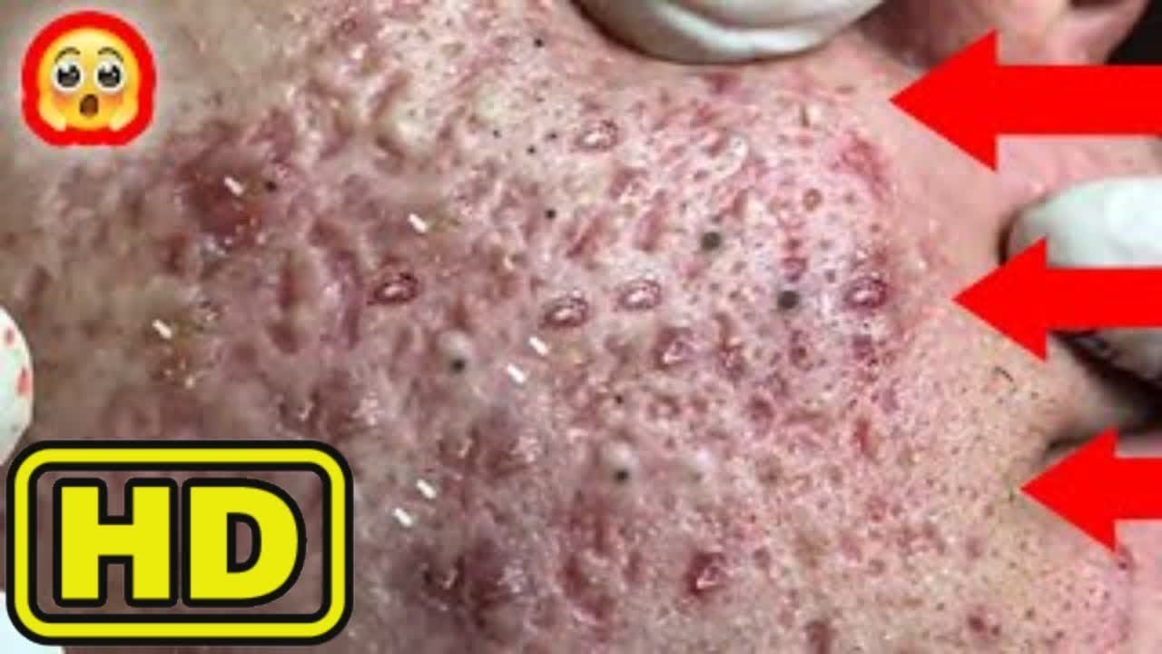 acne tv #004 | Milia, Cystic Acne, Nice pimples & Blackheads Extraction ...