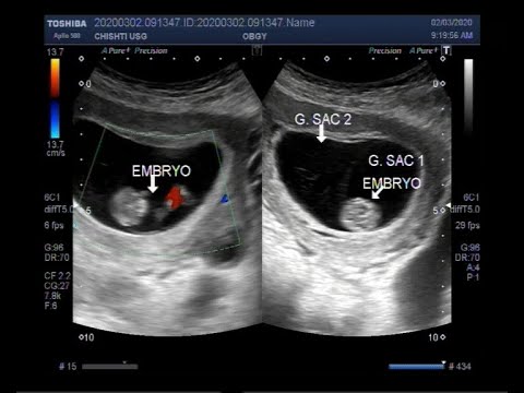 Ultrasound Video showing Vanishing twin syndrome with one normal fetus ...