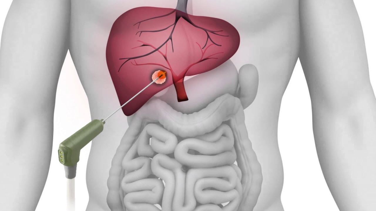 Microwave Ablation animation - YouTube