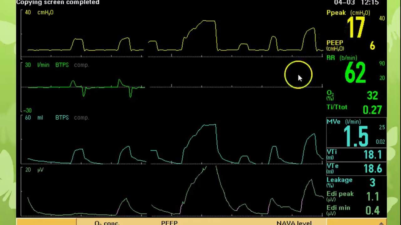 Troubleshooting NAVA and NIV NAVA Modes Project - YouTube