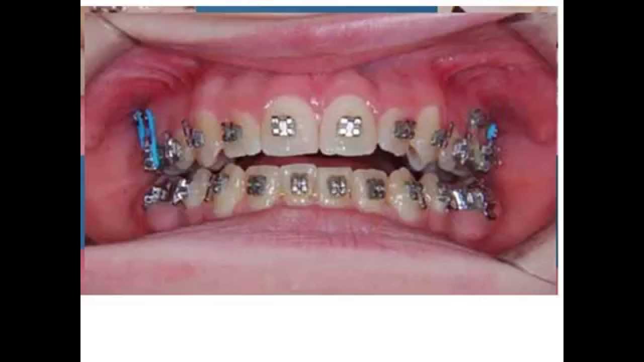 Open Bite Correction with 8 Miniscrews!! - YouTube