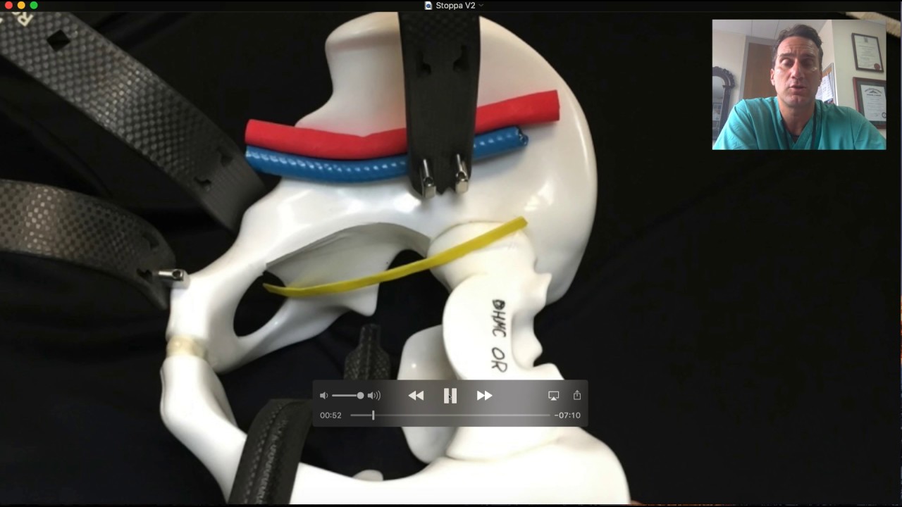 Modified Stoppa Approach by Cyril Mauffrey - YouTube