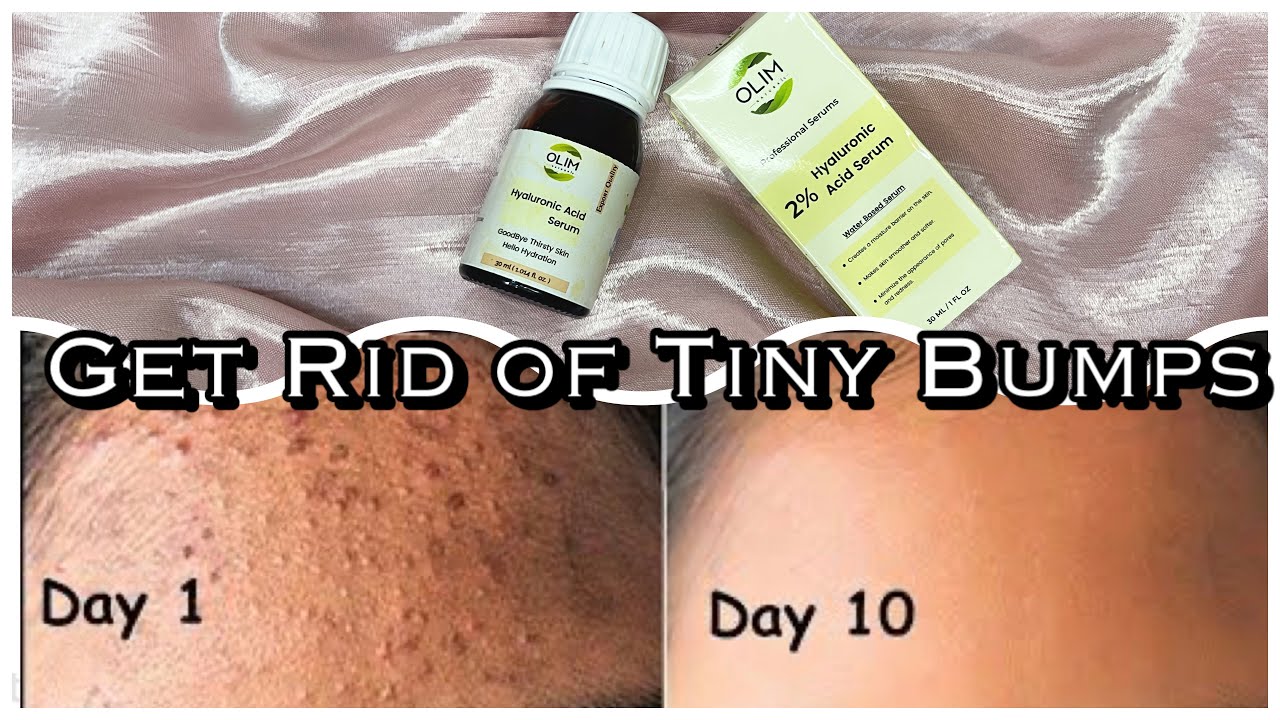 HOW TO GET RID OF BUMPS ON FACE \ OLIM 2% HYALURONIC SERUM \ Vegan ...