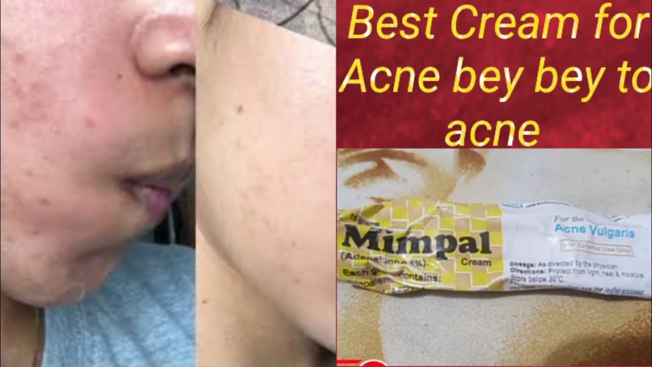 Mimpal Cream Review 100 Mimpal Cream Fo Acne Vulgaris Treatment How To