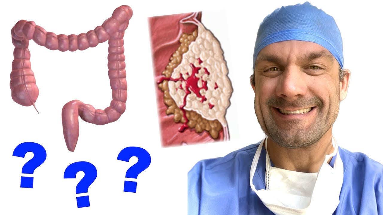 Colorectal Cancer Explained - What You Need to Know - YouTube