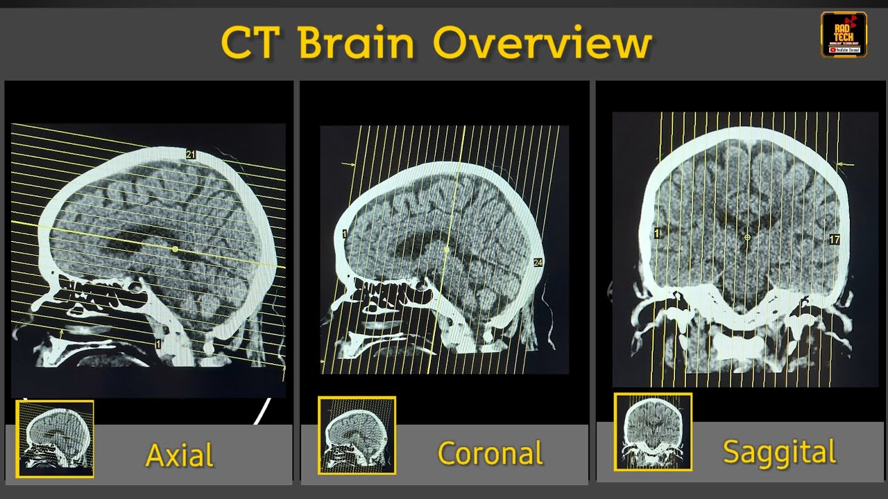 CT Brain Overview / Axial, Coronal & Sagittal. .. - YouTube