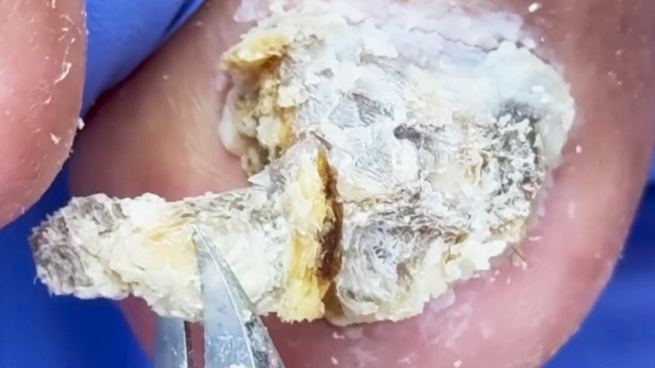Super Thick Nails! Thick Nails Are Pulled Out Layer By Layer【Dr. Liu's ...