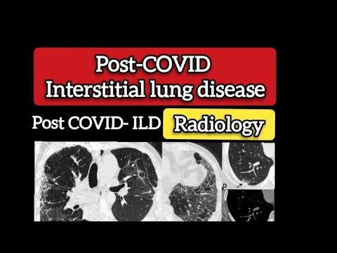 Post - COVID interstitial lung disease (Post COVID ILD) - Radiology ...