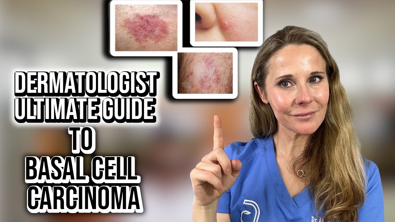 Dermatologist ultimate guide to Basal Cell Carcinoma - YouTube
