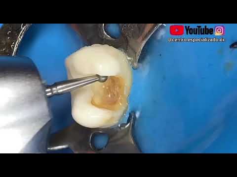 ¡Eliminación de tejido muerto en un diente! - YouTube