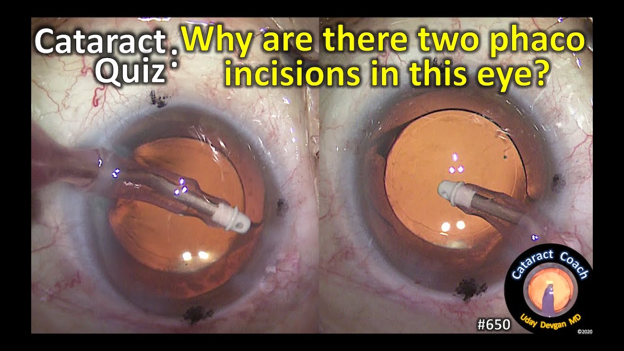 Cataract Quiz: Why are there two phaco incisions in this eye? - YouTube