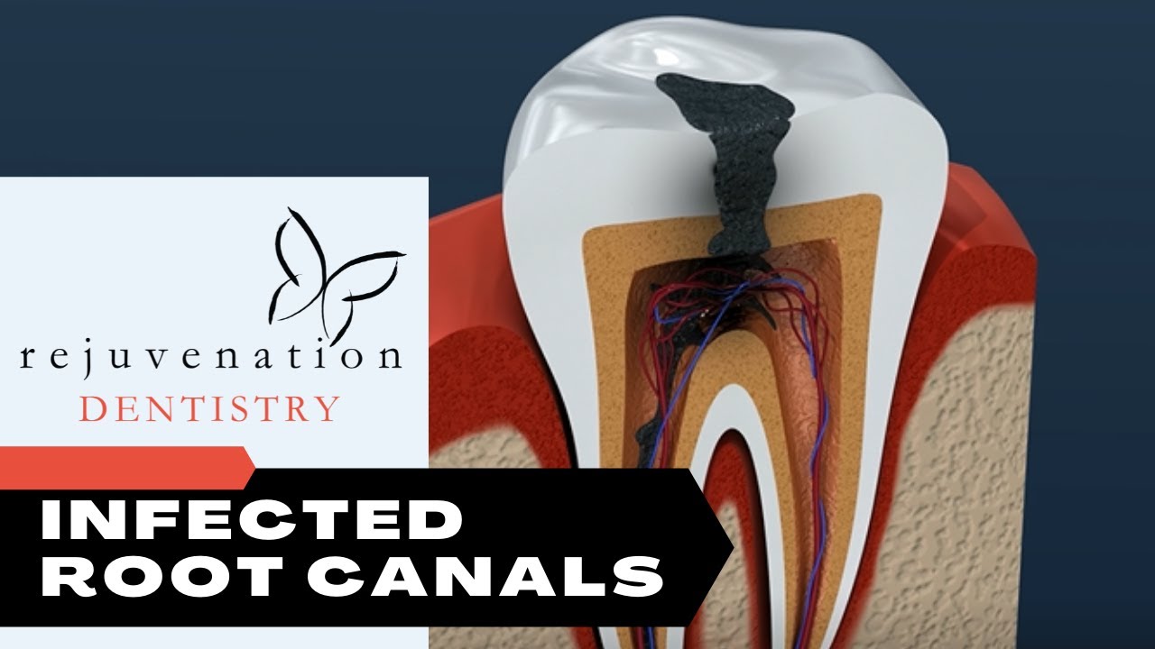 Infected Root Canals Can Be Major Sources Of Chronic Inflammation And ...
