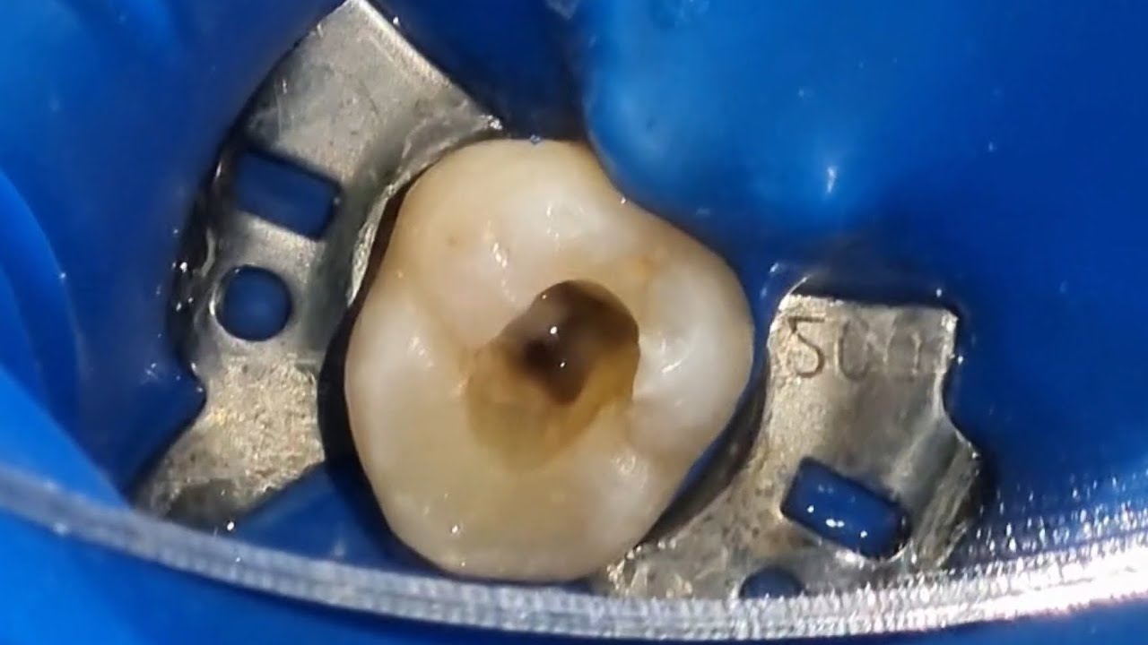 Dente 47 - canal e restauração - YouTube