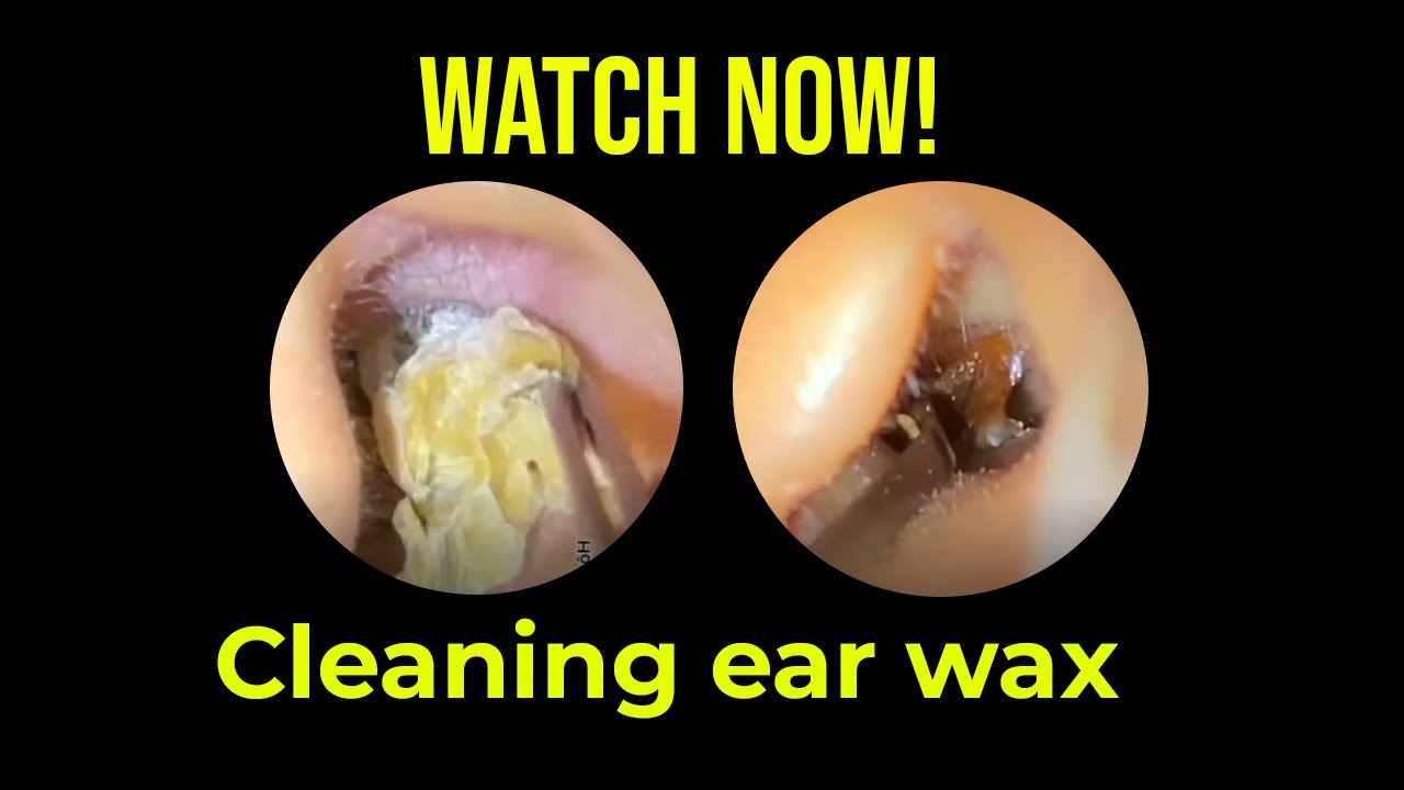 Must Watch! Huge Earwax Blockage Removed |ear wax removal | ear ...