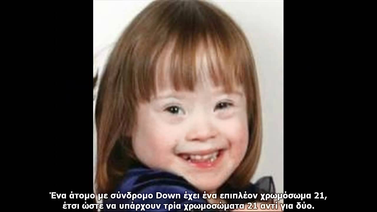 Σύνδρομο down. - YouTube