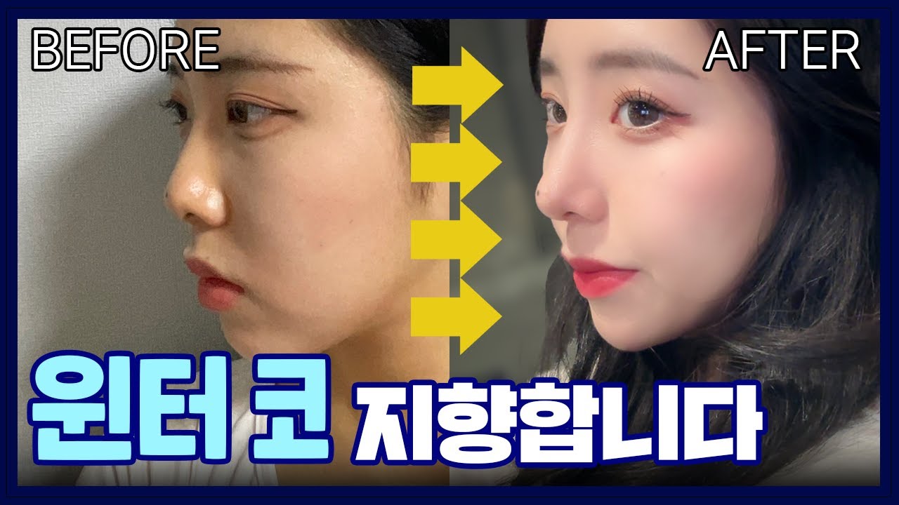 코성형후기 자연스럽게 윈터 코 갖고 싶어요😚 코성형후기 성형레전드 |서울아이성형외과 Youtube